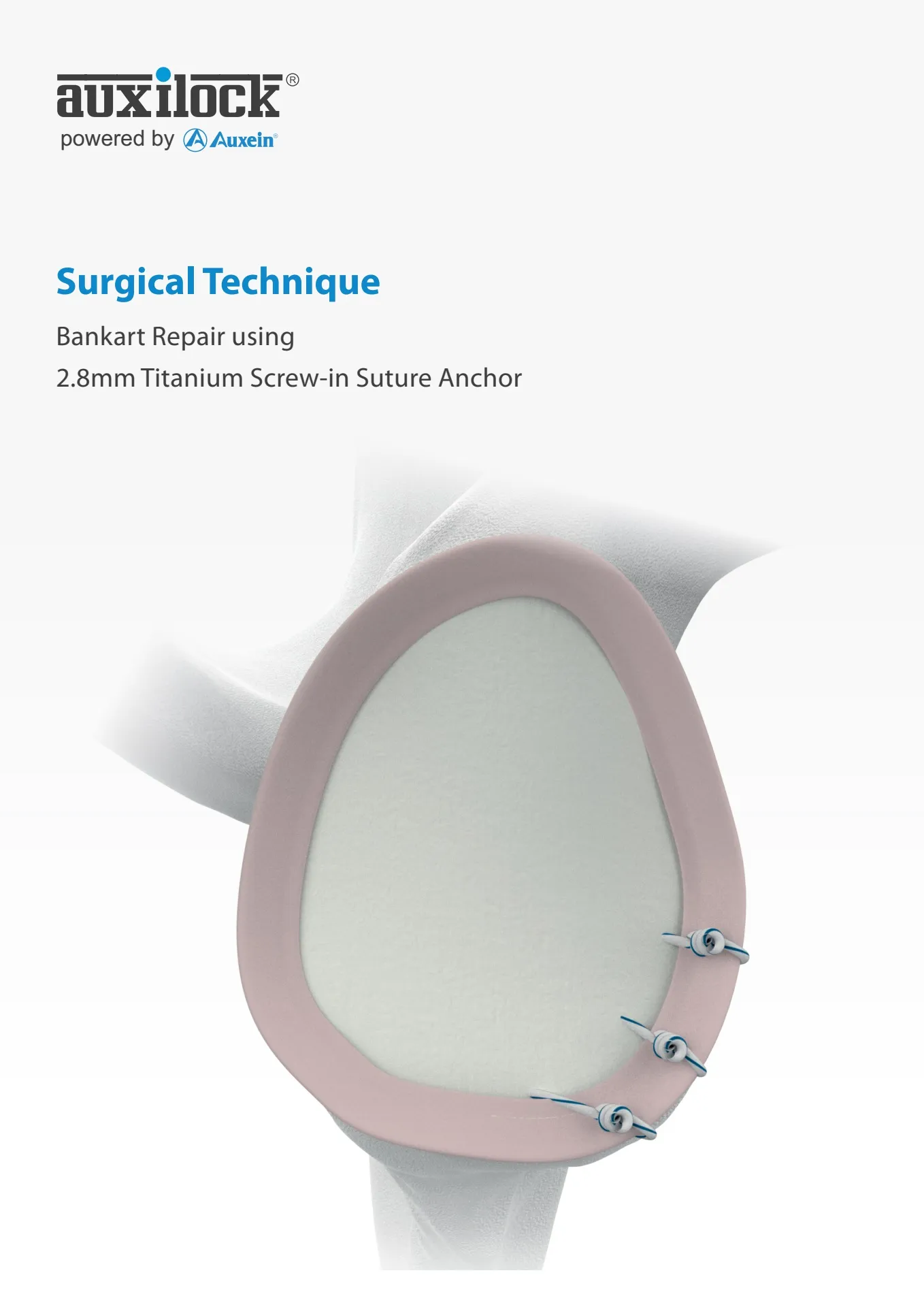 2.8mm Titanium anchor